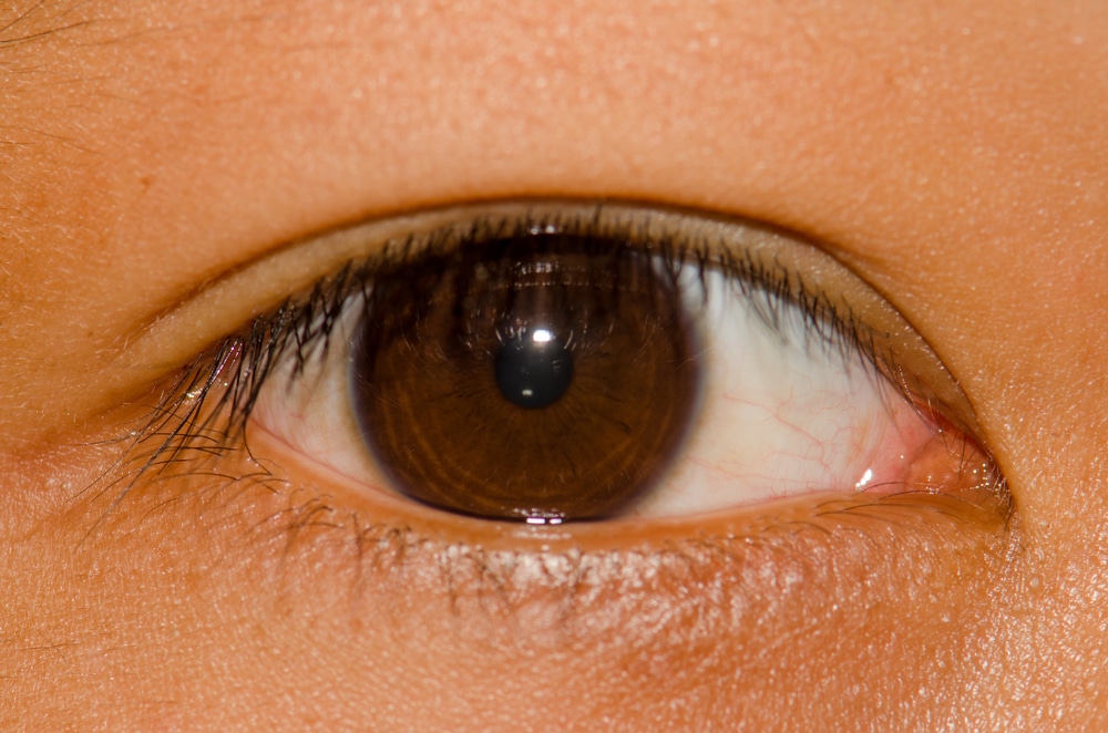 Treating minor eye injuries | Baby Arabia